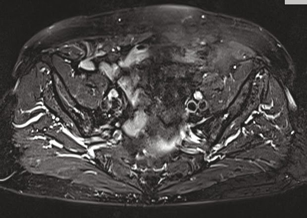 RADIODIAGNOSIS - IMAGE COLLECTION: MRI in Spigelian Hernia