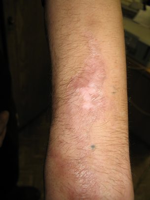 Deformutilation: Desomorphine aka Krokodil II