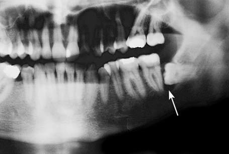 Dentistry and Medicine: Impacted Mandibular 3rd Molar Classification ...