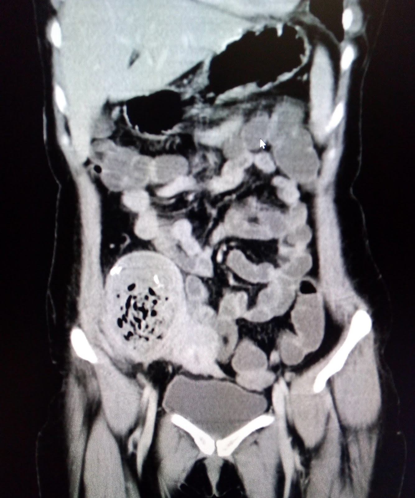 Two cases of Gossypiboma -Teaching Points - Sumer's Radiology Blog