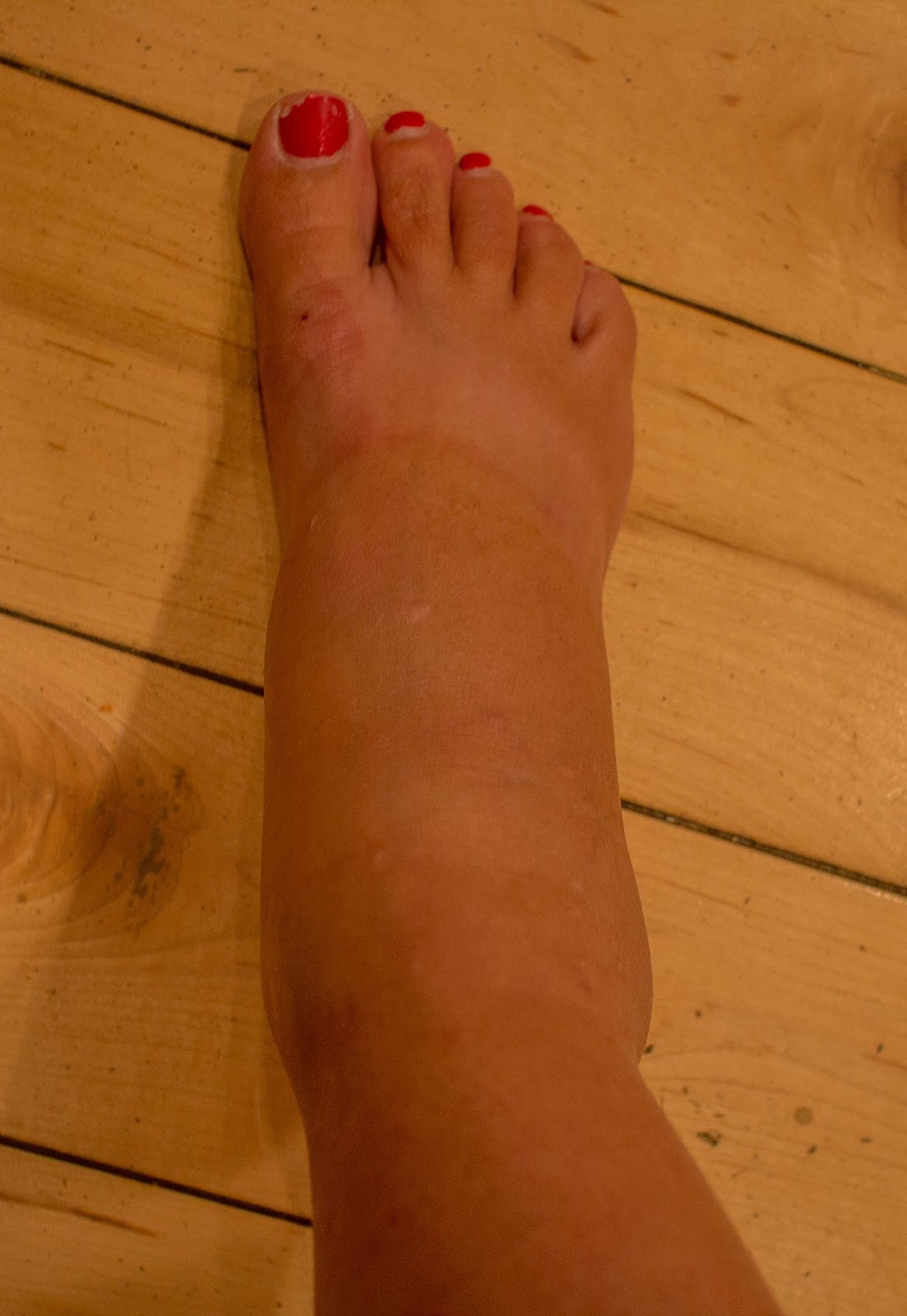 THE ERICKSON FAMILY: Fat Foot Syndrome