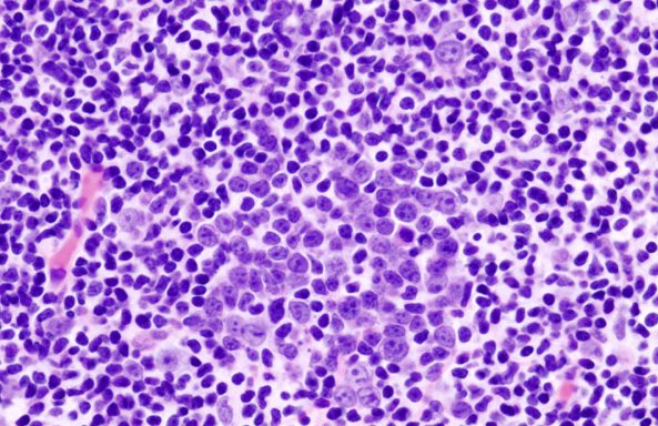 Diffuse Large B Cell Lymphoma Staging (DLBCL)