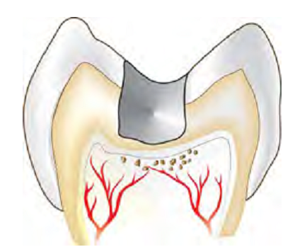 Entendiendo mi sonrisa : Pulpitis Reversible e Irreversible