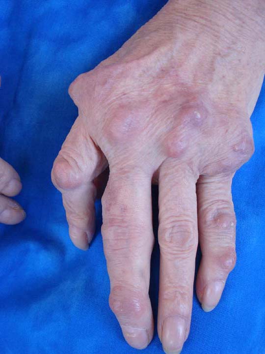 VIRTUAL GRAND ROUNDS IN DERMATOLOGY 2.0: A Complex Patient