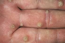 Photos of Warts on Hands and Fingers ~ How To Remove Moles, Warts, Skin ...