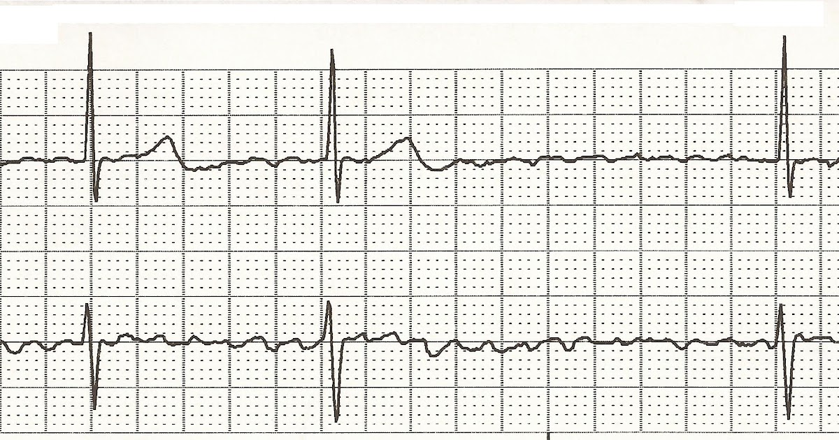 EKG Rhythm Strips 73