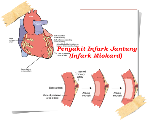 Obat Infark Jantung Tradisional | Obat Ampuh Multi Khasiat