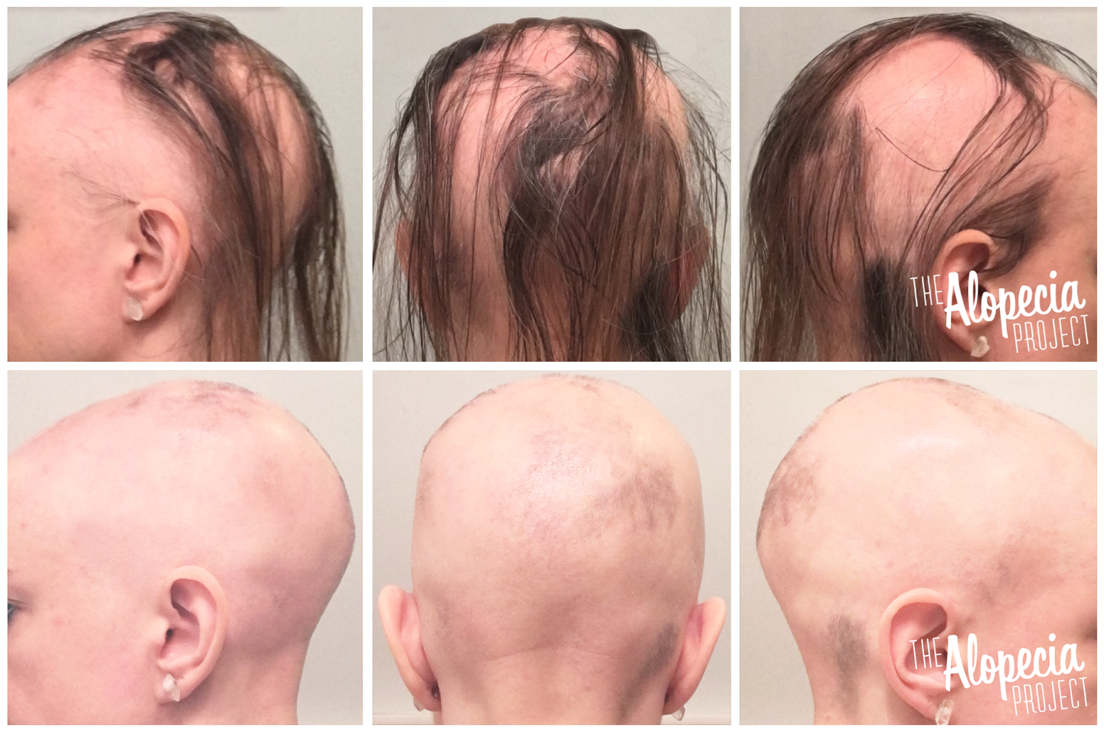 the alopecia project.