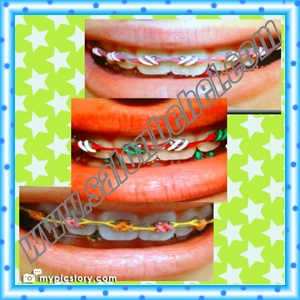 LN Clinic behel semarang: BEHEL PERAWATAN ,FASHION & LEPAS PASANG