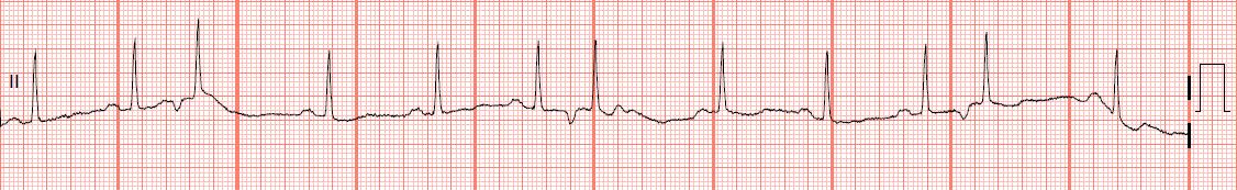 EKG Rhythm Strips 11- ectopic beats