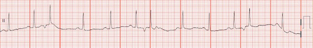 EKG Rhythm Strips 11- ectopic beats