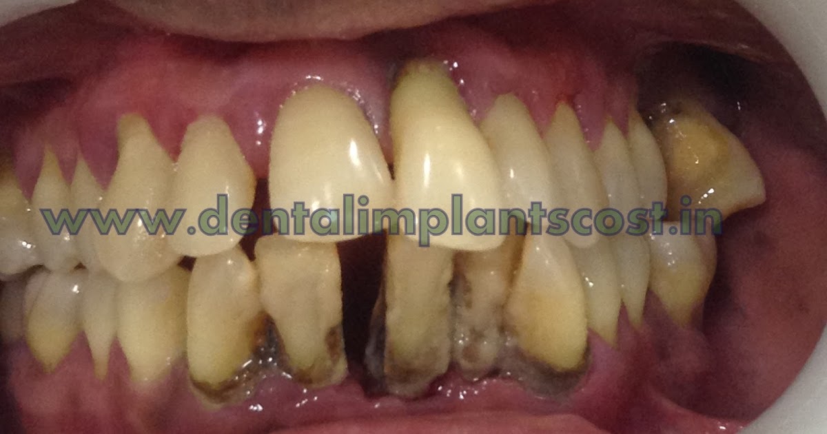 Dental Clinic In Santhoshapuram, Chennai: Mobile Tooth Replacement with ...