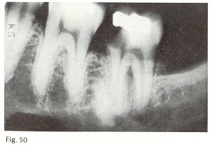 WizDent: Condensing Osteitis