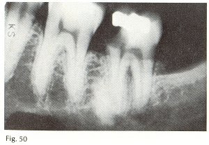 WizDent: Condensing Osteitis
