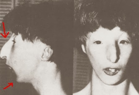 Síndrome de Seckel : Enfermedades Congénitas: Síndrome de Seckel