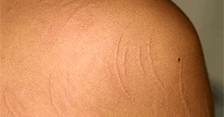 Dermographism- Symptoms, Causes & Herbal Treatment - Dr. Vikram's Blog ...