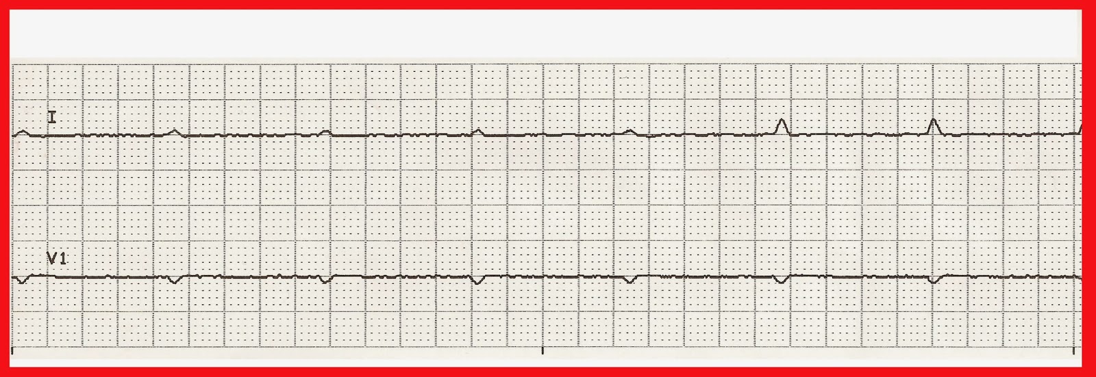 Basic EKG Rhythm Test Final Exam 2013