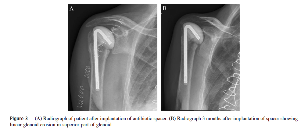 UW Shoulder and Elbow Academy: Are antibiotic spacers a benign ...