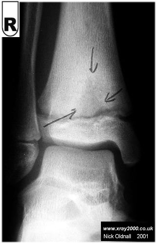 Medische Kennis: Brodie's abcess (subacute osteomyelitis)