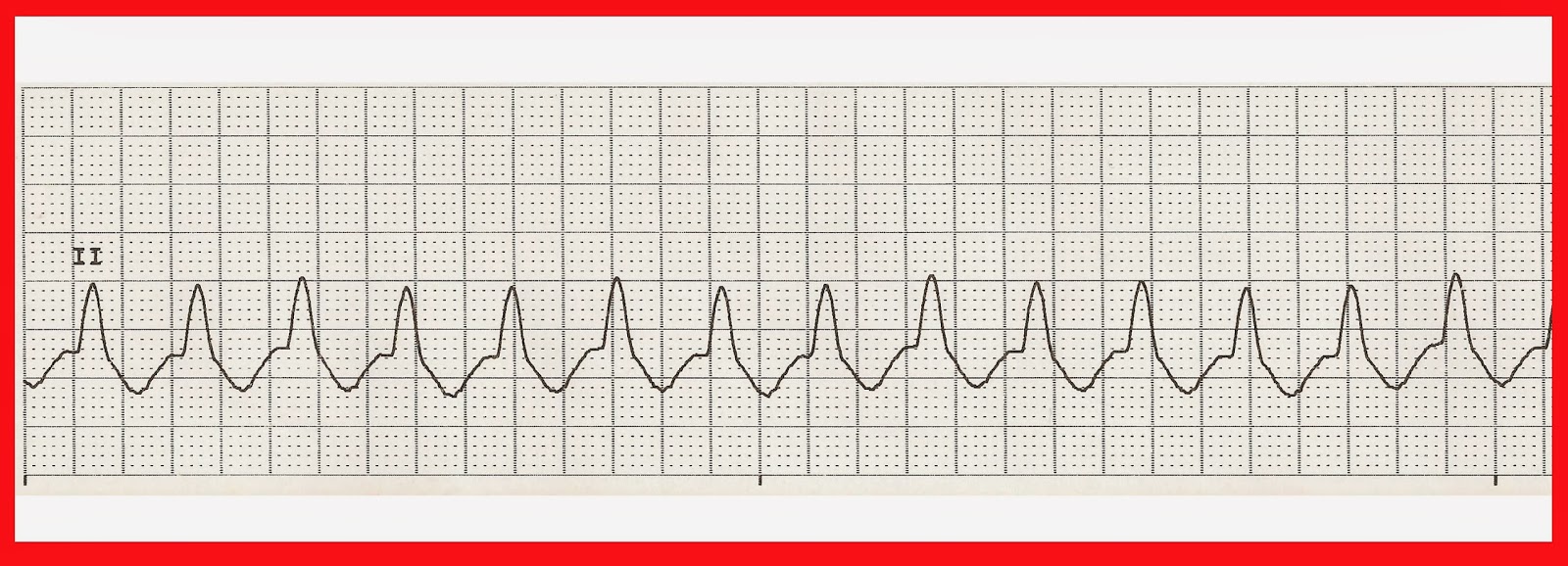 Practice EKG Rhythm Strips 219