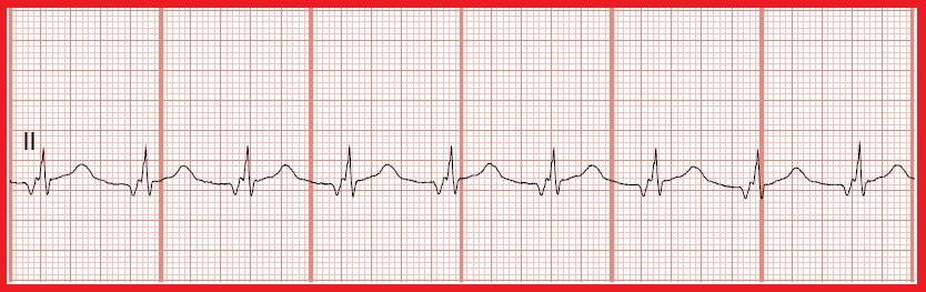 Characteristics of Junctional Rhythms