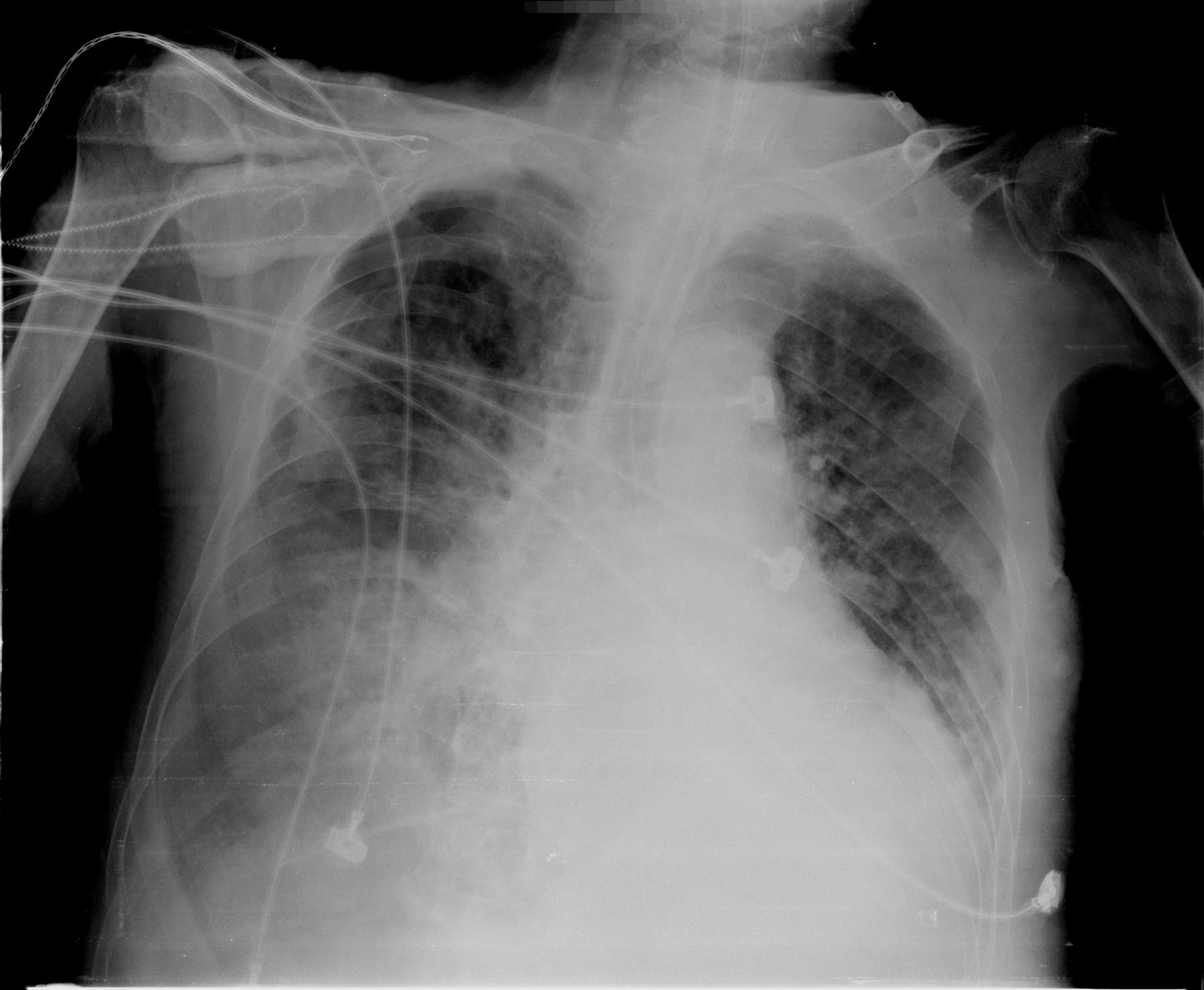 CXR 胸部x光判讀 pneumothorax