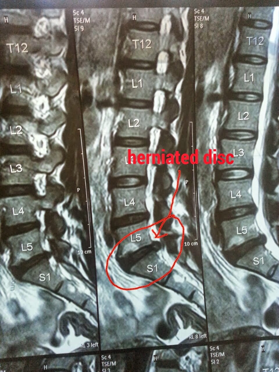 Terapi Tulang Pinggul, Saraf dan Sendi: Mei 2014