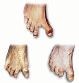 Hallux varus ~ Anatomy for MSP