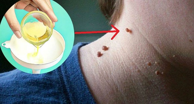 How To Remove Fibroma And Other Skin Warts All By Yourself