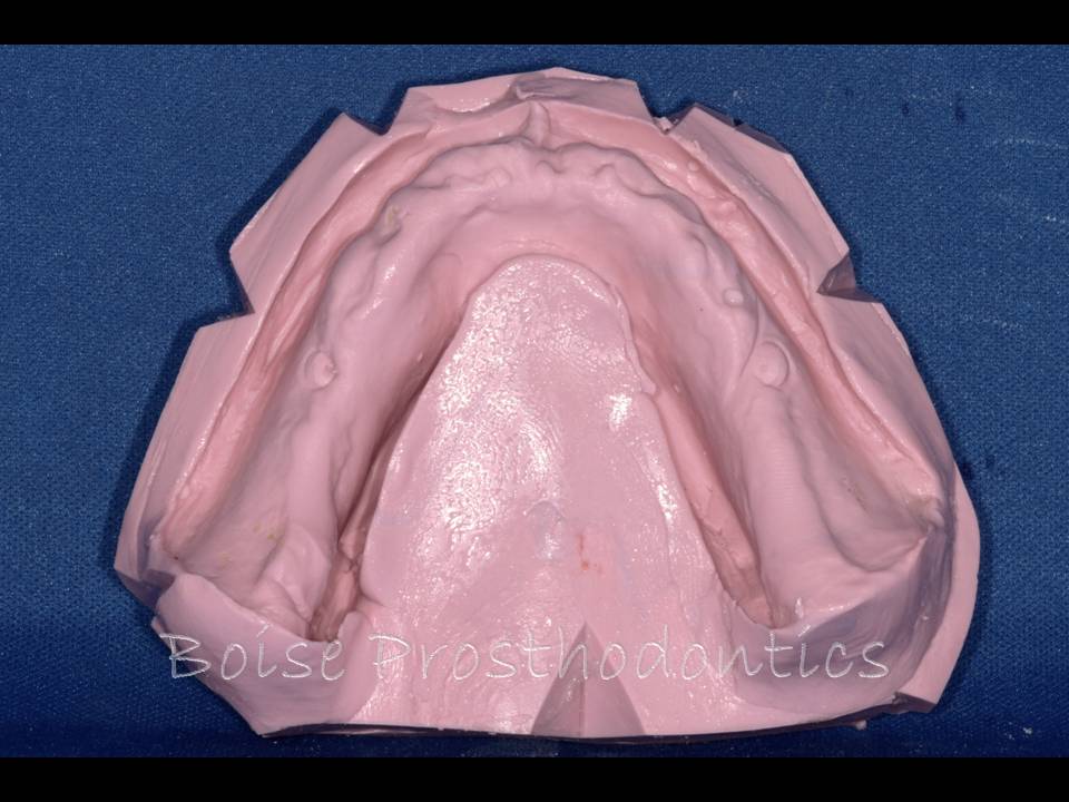 Boise Idaho Prosthodontics: Picture Sequence of Maxillary Complete ...