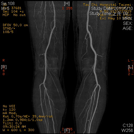 淨元法師之大醫院小醫師: right CFA saddle thrombus status post type A dissection ...