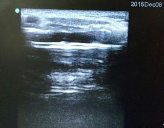 Intensity: The Double Line Sign