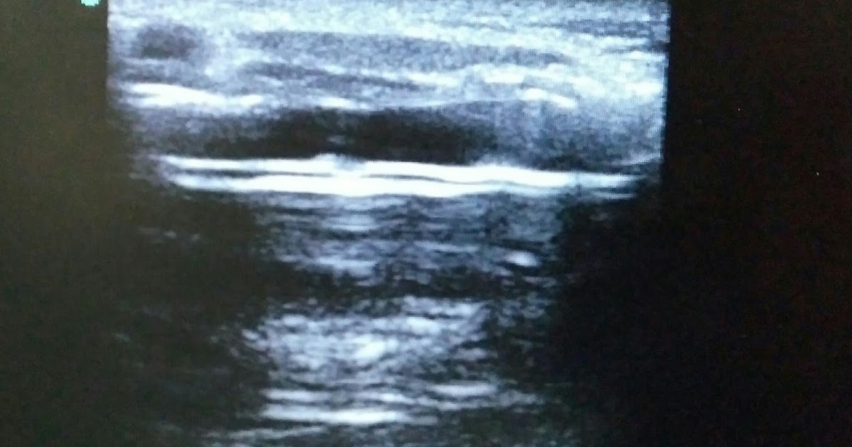 Intensity: The Double Line Sign