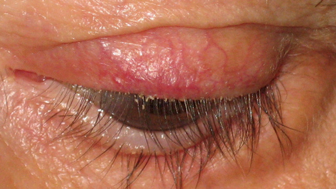 Blog De Optica Conforvision ¿tengo Caspa En Los Ojos