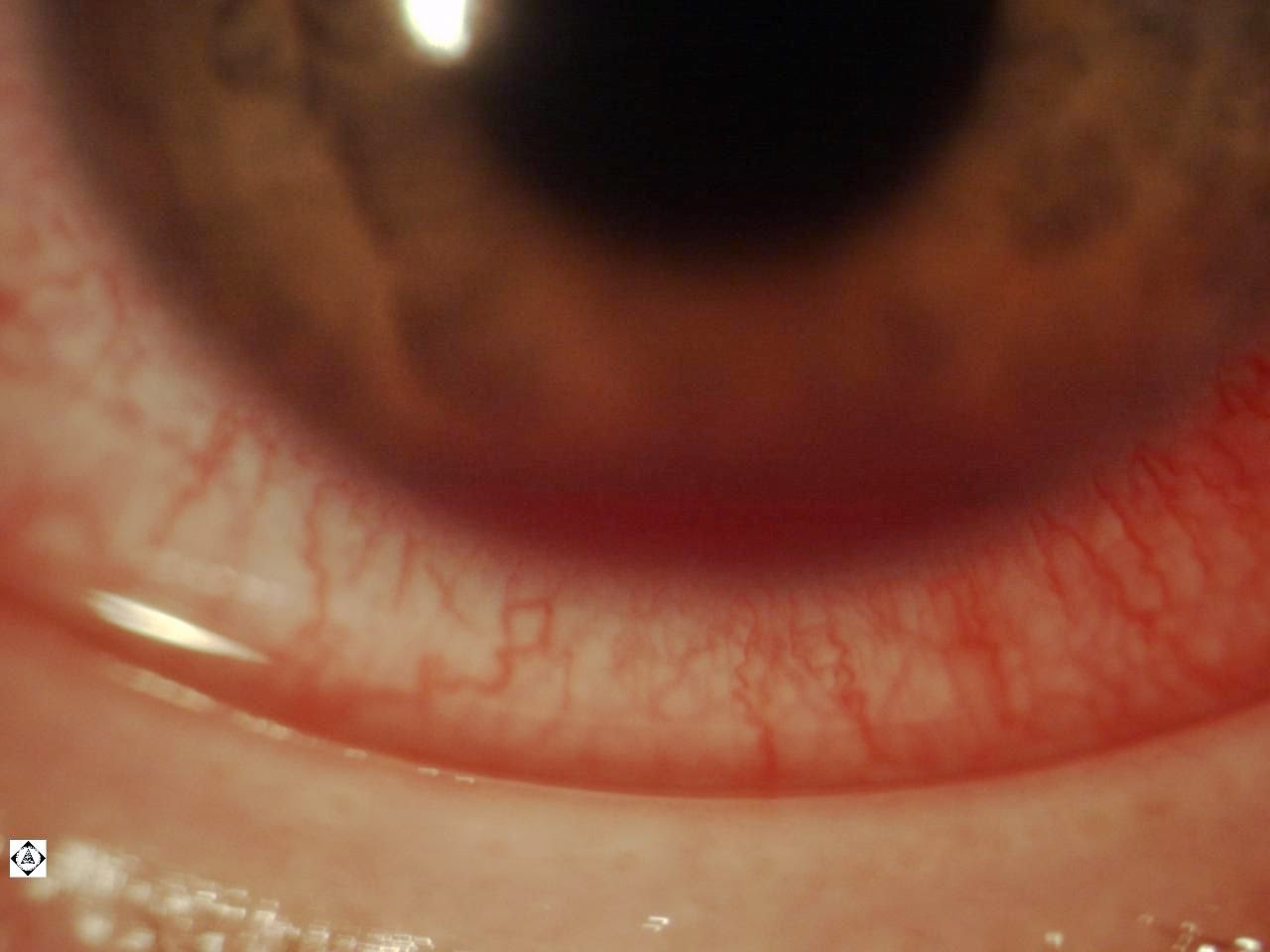 Sonoran Desert Eye Center: TRAUMATIC HYPHEMA