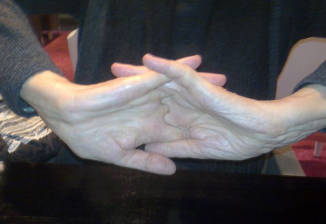 Handrehabilitationcase with Dupuytren's contracture.: A trauma in the ...