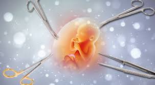 John Donald Simamora: ABORSI