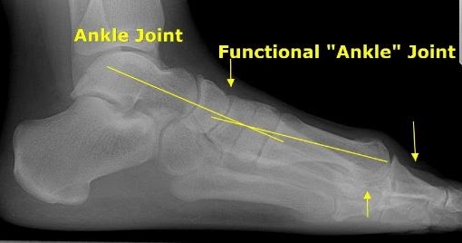 Central Massachusetts Podiatry: Hallux Limitus (a.k.a. Arthritis of the ...