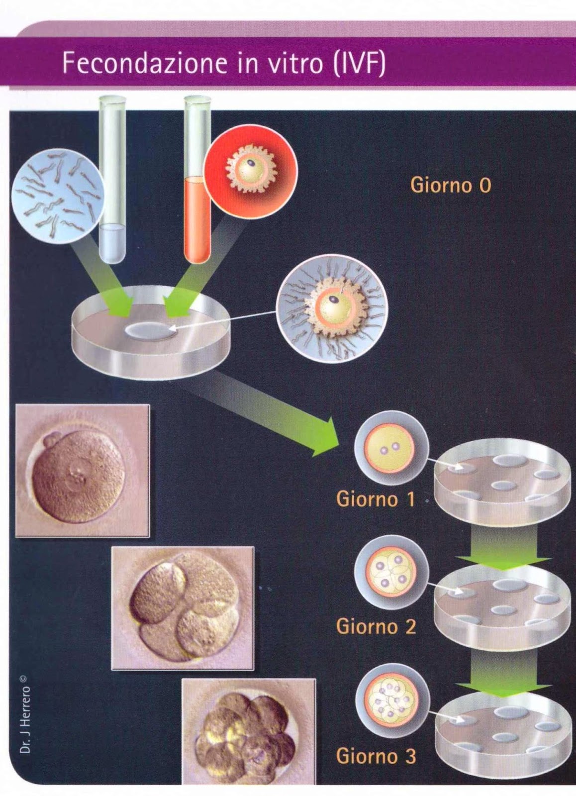 FIVET - FERTILIZZAZIONE IN VITRO