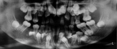 zaza: Radiofotografi 1 : film dental dan panoramic