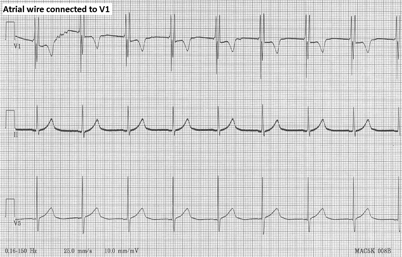 Pedi cardiology: Quiz, EKG: What is the rhythm? Junctional vs. Low ...