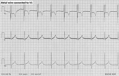 Pedi cardiology: Quiz, EKG: What is the rhythm? Junctional vs. Low ...