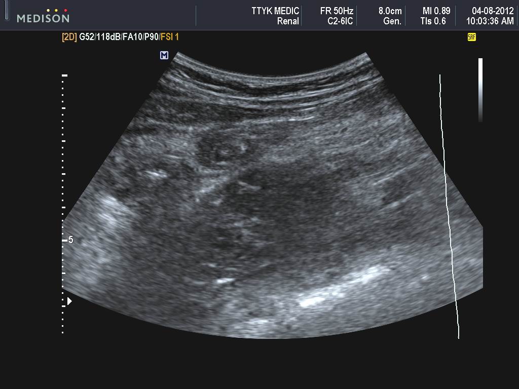VIETNAMESE MEDIC ULTRASOUND: CASE 137: APPENDIX TUMOR, Dr PHAN THANH ...