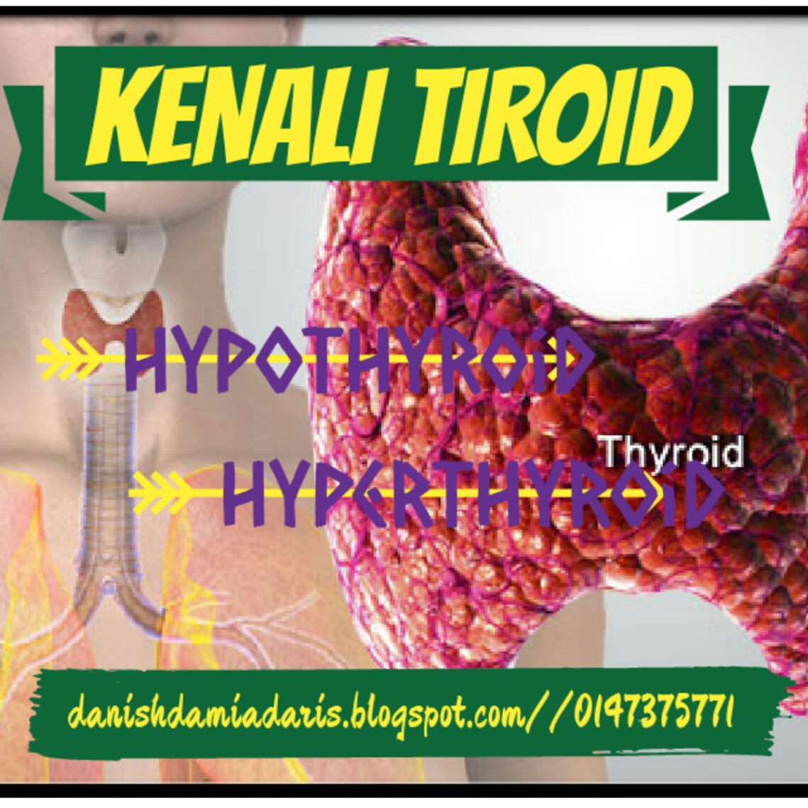 3D health beauty supplement: KENALI TIROID ; PUNCA, GEJALAN DAN CARA ...