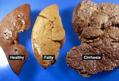 Dr Sherazi: Cirrhosis