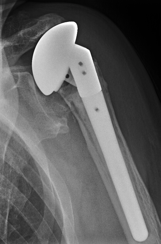 Shoulder Arthritis / Joint Replacement : Reverse total shoulder - does ...