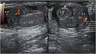 Torsion of testicular appendix ……an Ultrasound & Color Doppler ...