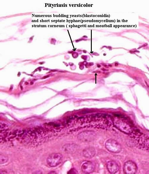 Infeksi Jamur Kulit Superfisial "Panu" | AGP88