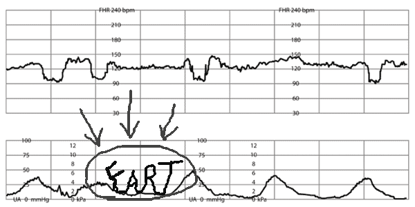 A Fart on the Chart