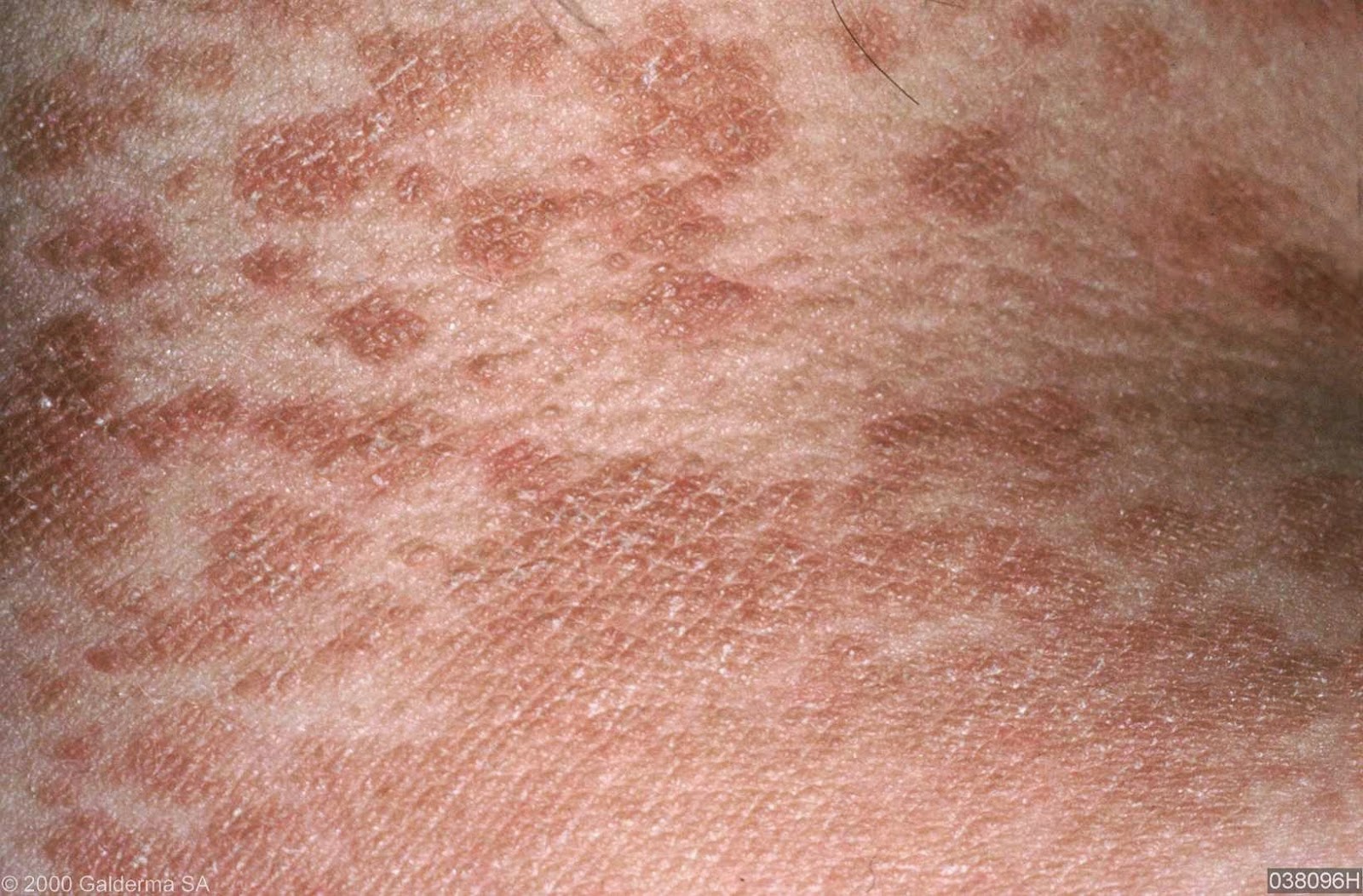 SKIN DISEASE TYPES: Tinea Versicolor